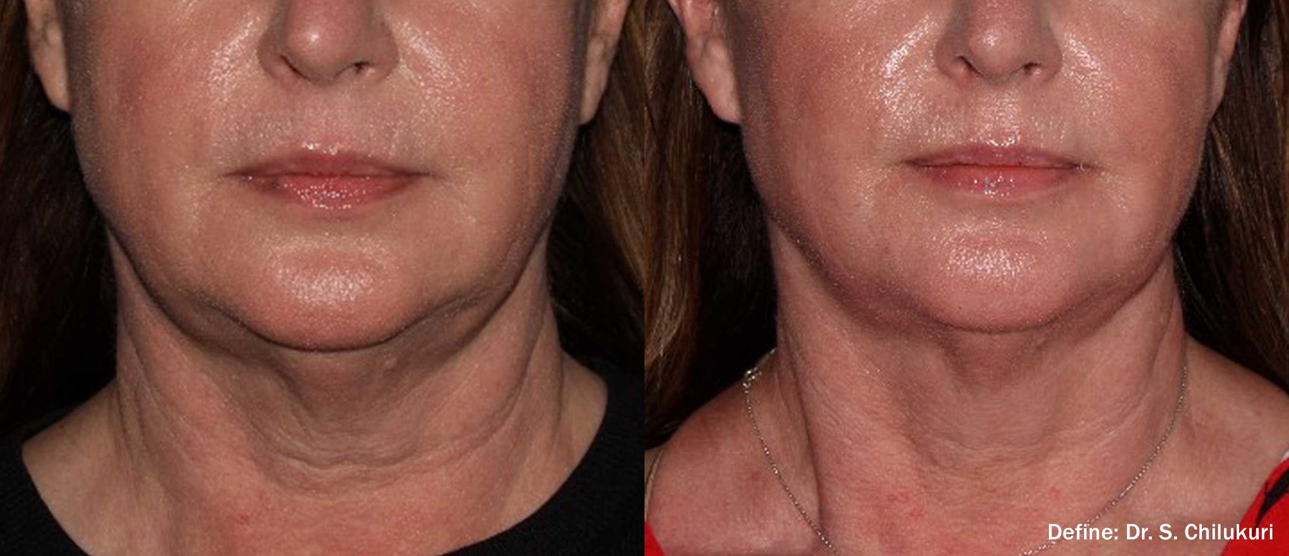 DefineCheek /Chin: remodelação facial sem mãos